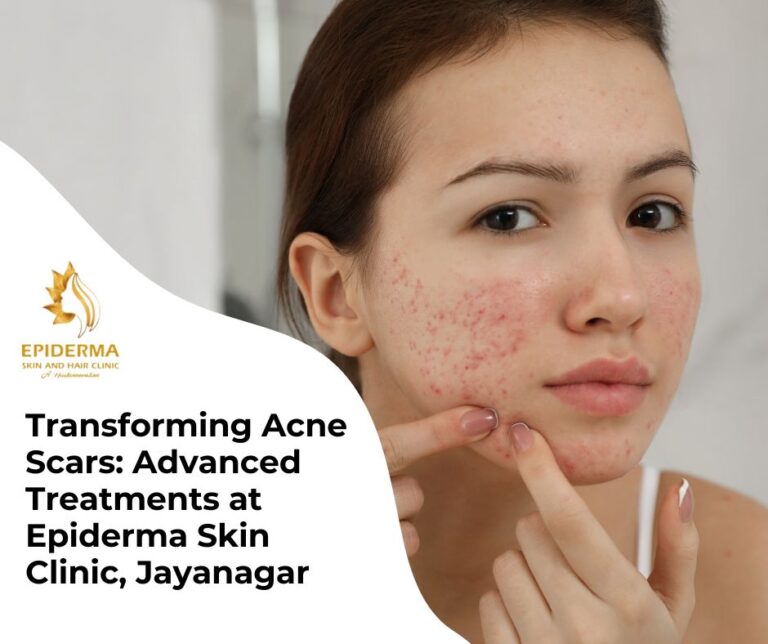 Acne Scars Treatment in Jayanagara | Epiderma